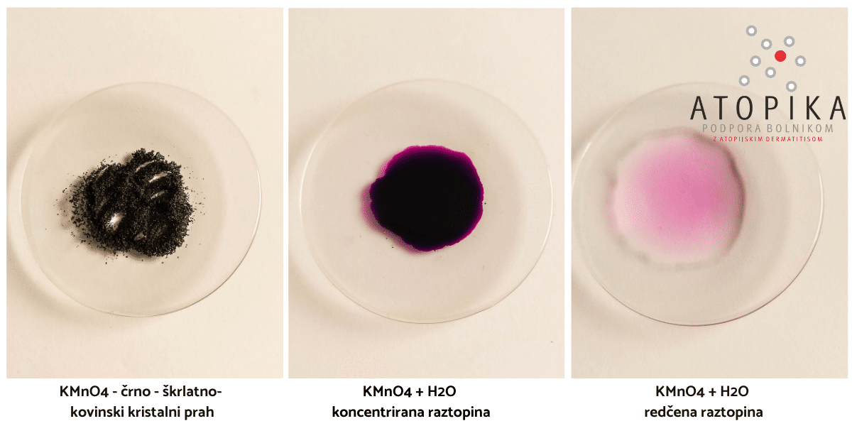 Potassium permanganate bath and atopic dermatitis - Atopika